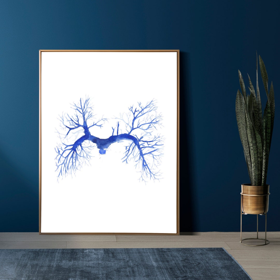 Pulmonary Embolism Angiography, CT Angio, Radiology Art Print ...