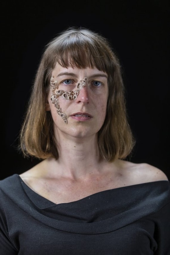 human skin barnacles pictures