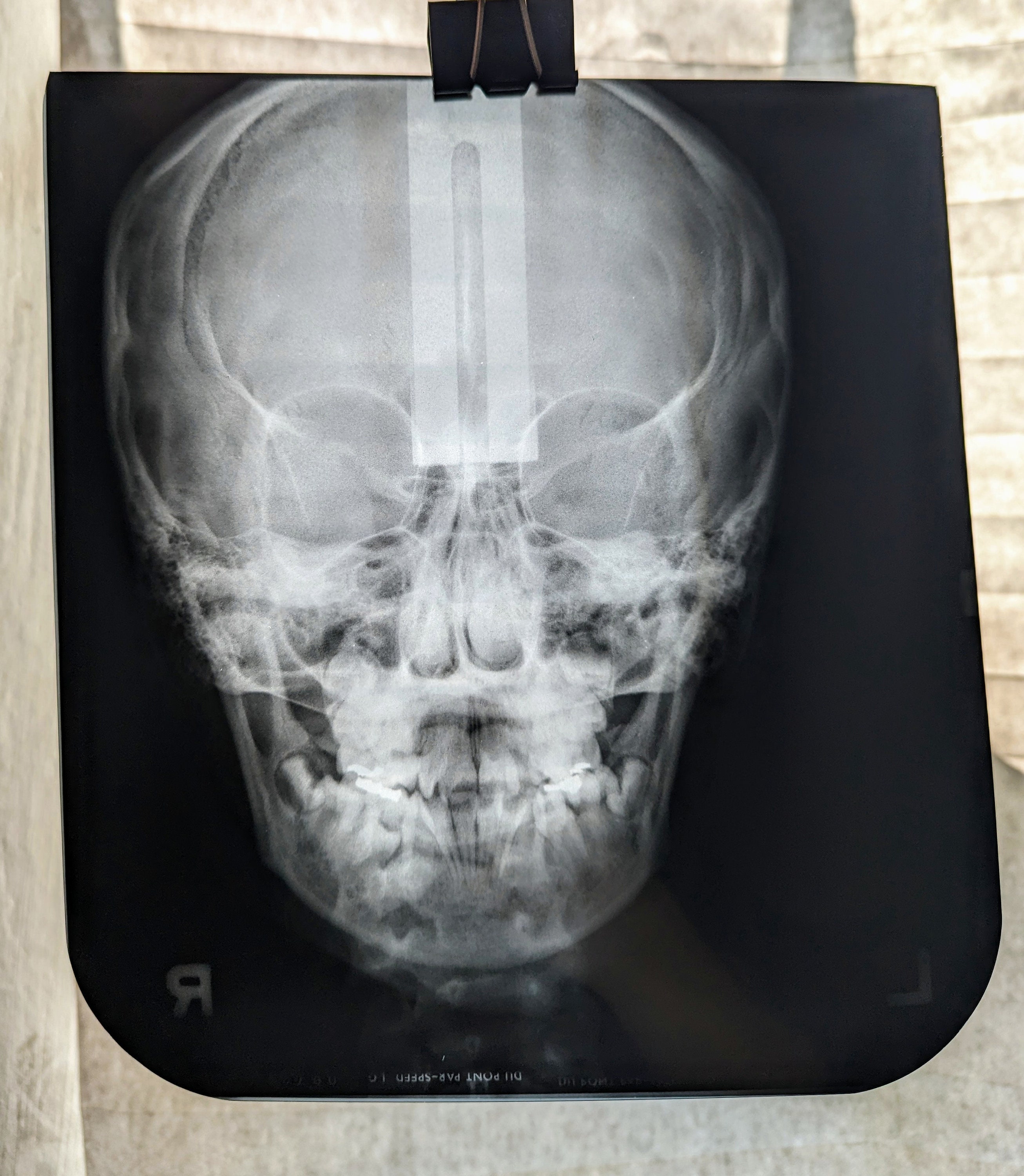 Broken Skull X Ray