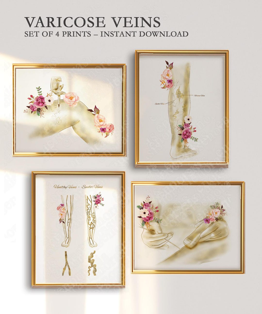 Varicose Veins Anatomy Poster Set, Vascular Wall Art, Vein Treatment ...