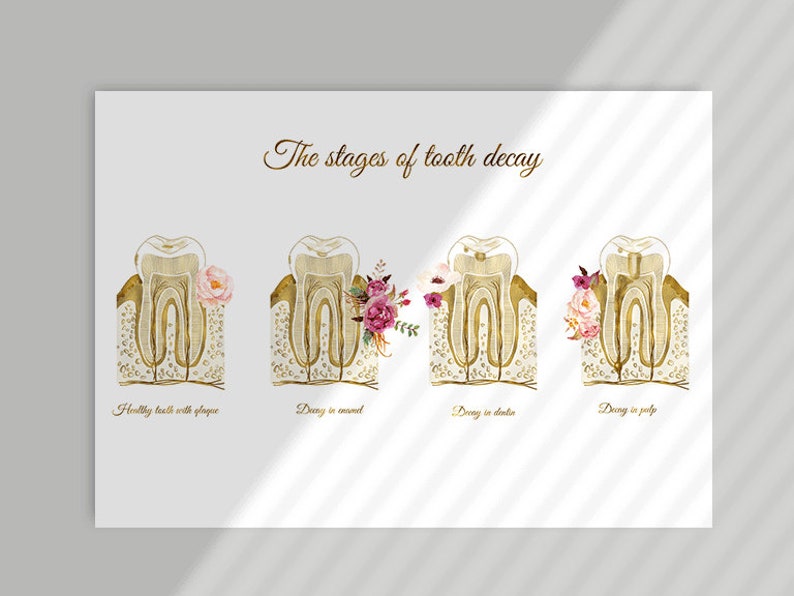 The Stages of Tooth Decay Print Dentist Poster Dental - Etsy