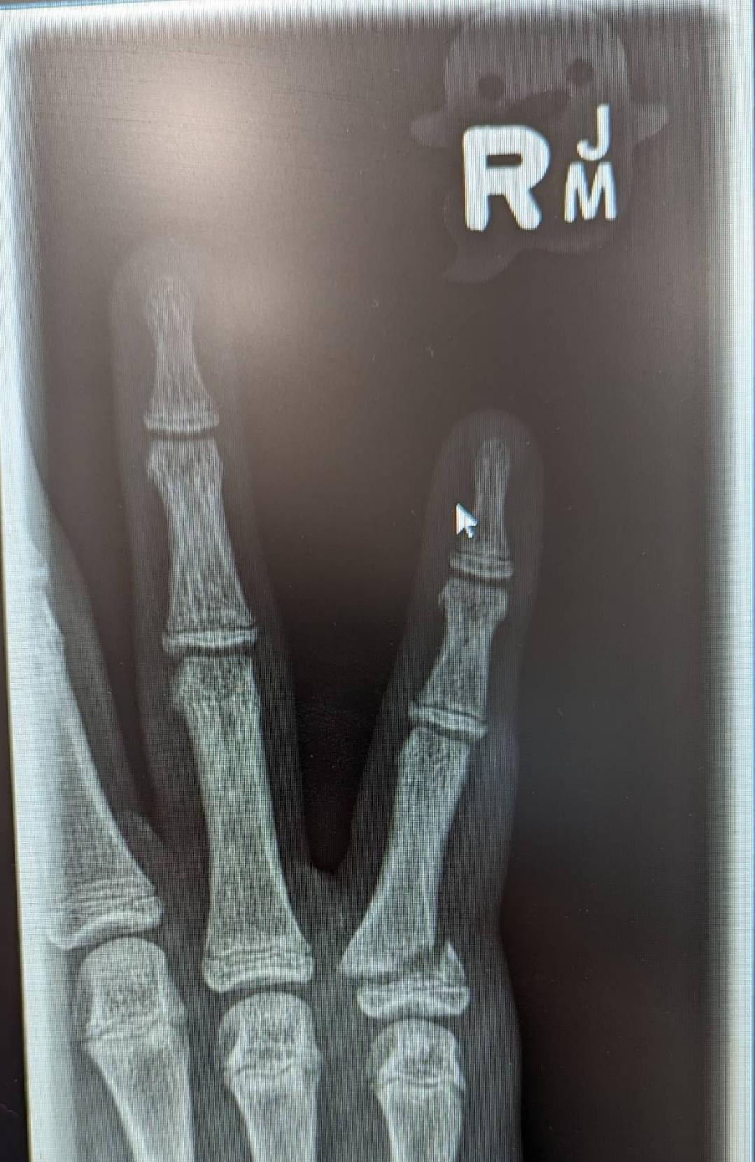 Ghost Xray Markers up to 3 Letters or Numbers Radiology, Xray Markers ...