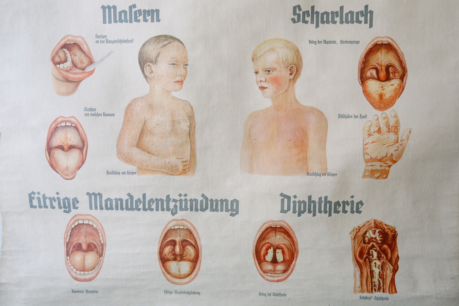 Original ANATOMICAL Vintage German School Wall Chart CHILDHOOD DISEASES ...