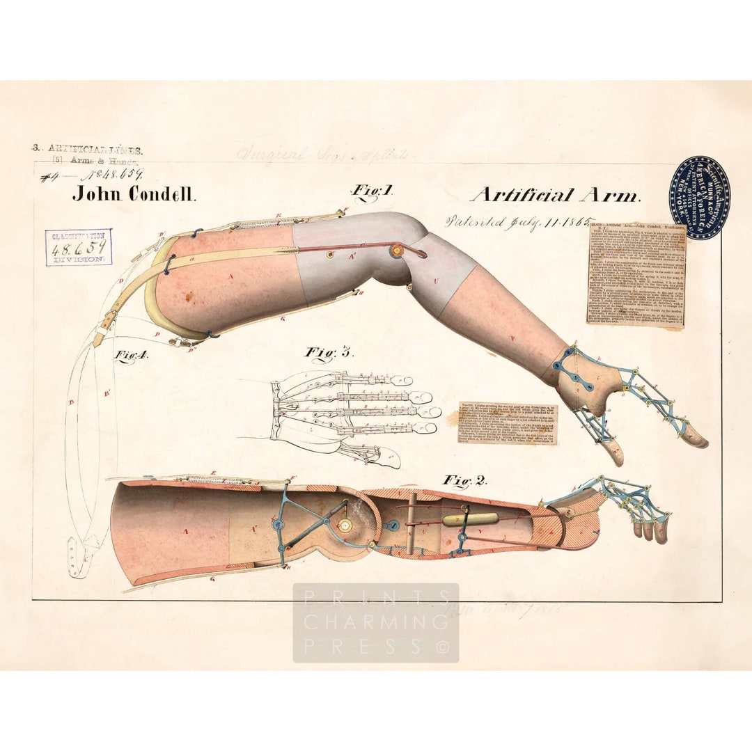 Vintage Anatomical Illustration of an 1865 Artificial Arm - Early ...
