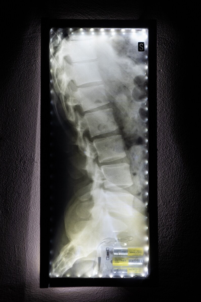 X-ray Led Lighted Picture With Spine, Brighted Radiography Picture ...
