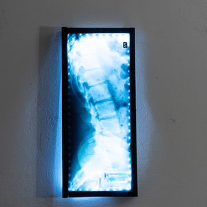 X-ray Led Lighted Picture With Spine, Brighted Radiography Picture ...