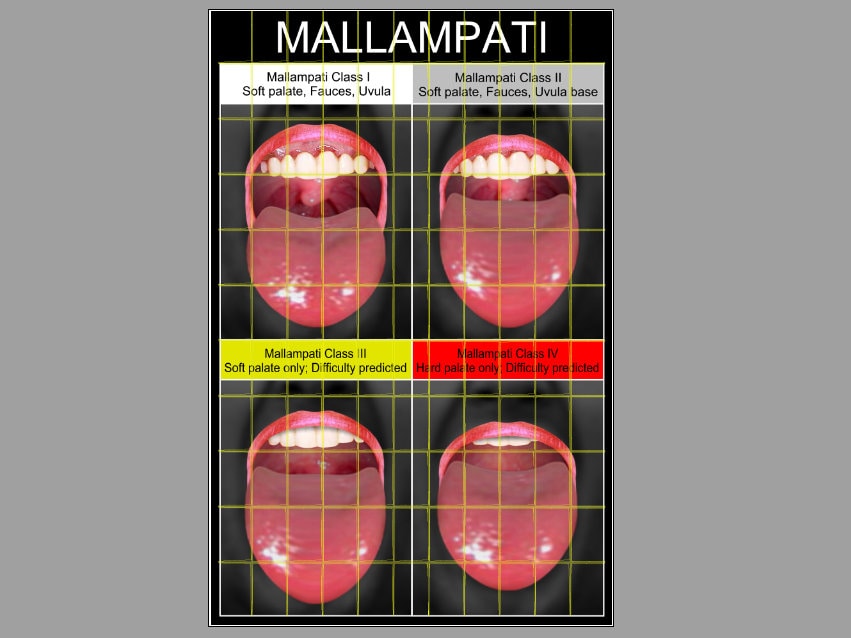 Mallampati Classification Anesthesia Airway Assessment Digital Download ...