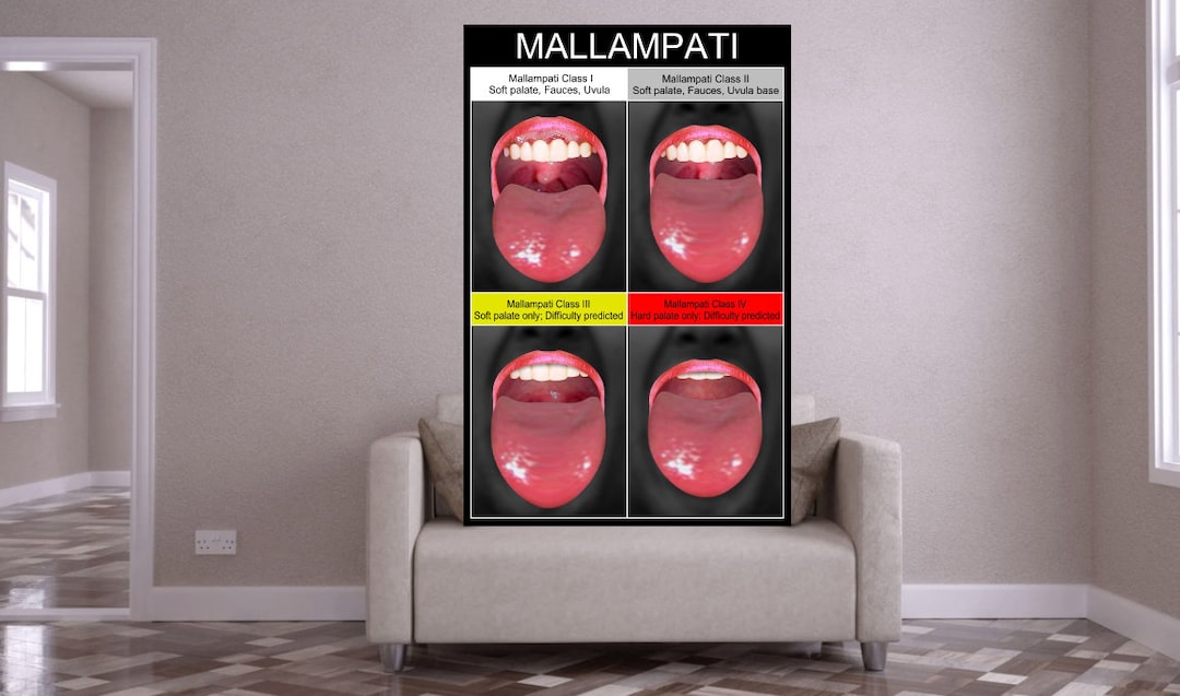 Mallampati Classification Anesthesia Airway Assessment Digital Download ...