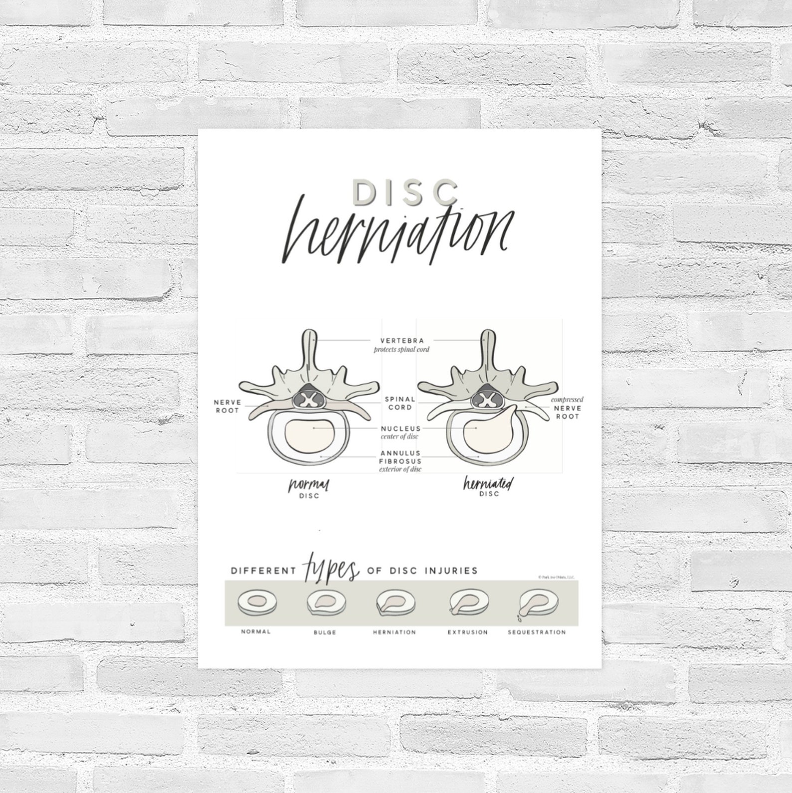New Disc Herniation Poster Chiropractic Spine Health - Etsy