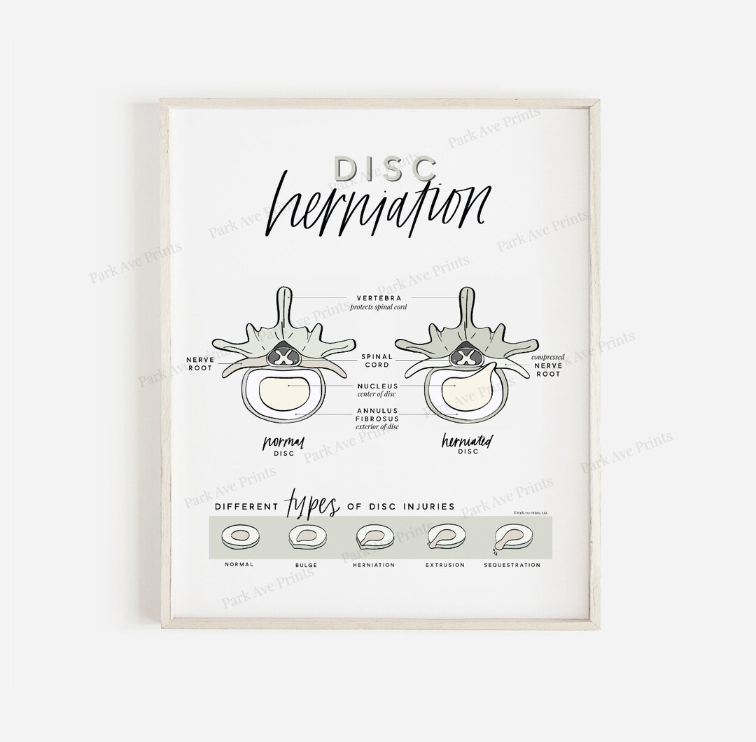 New! Disc Herniation Poster Chiropractic Spine Health - Etsy