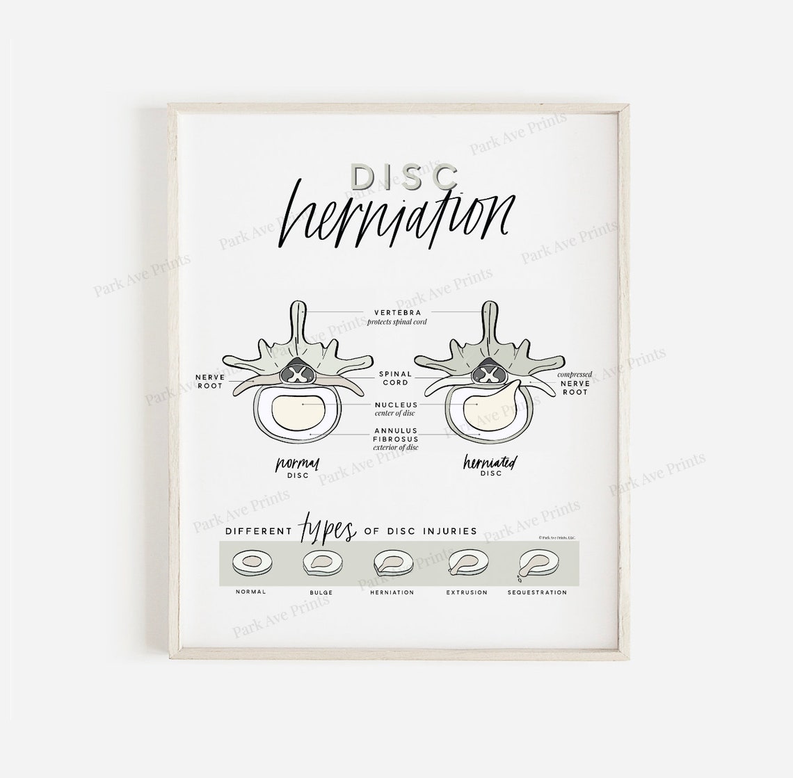 New Disc Herniation Poster Chiropractic Spine Health - Etsy