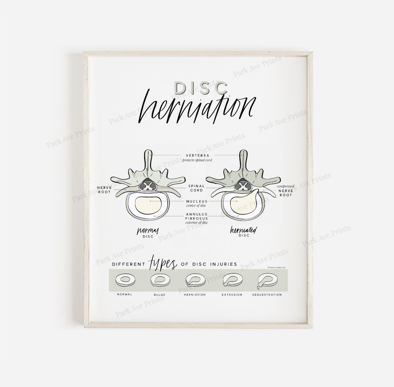 New Disc Herniation Poster Chiropractic Spine Health - Etsy