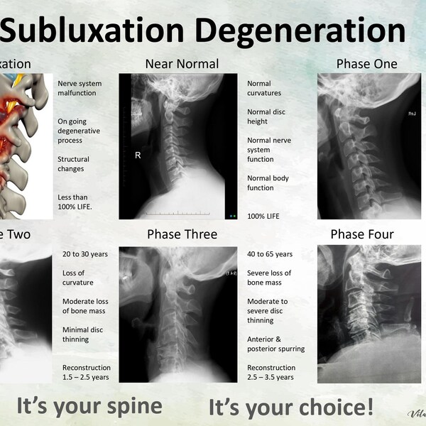 Subluxation Poster - Etsy