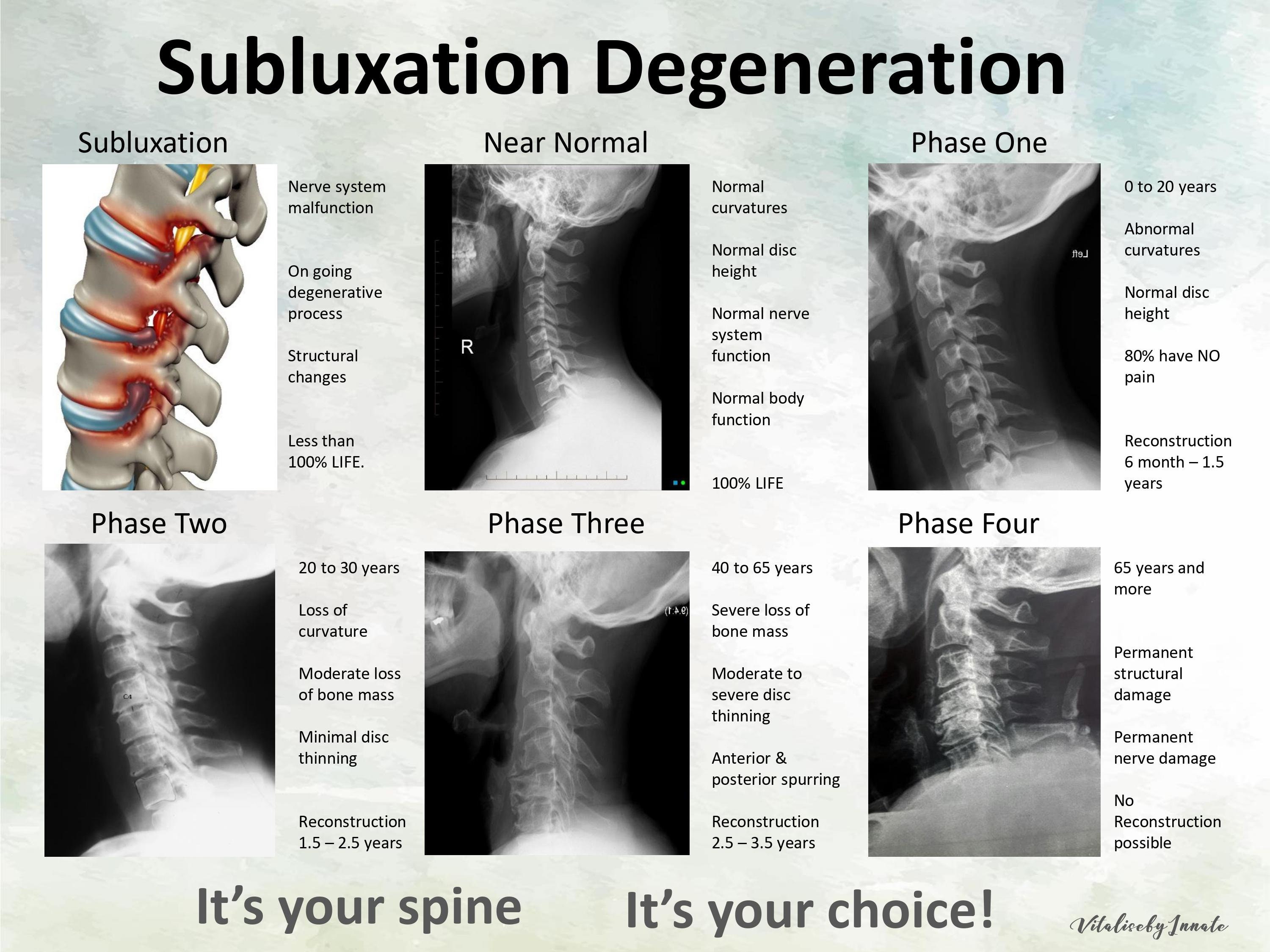 Chiropractic Subluxation Degneration Poster Cervical - Etsy