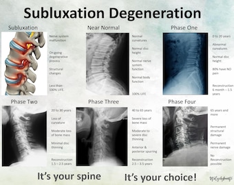 Subluxation Model // Chiropractic // Subluxation Complex // Symptoms ...