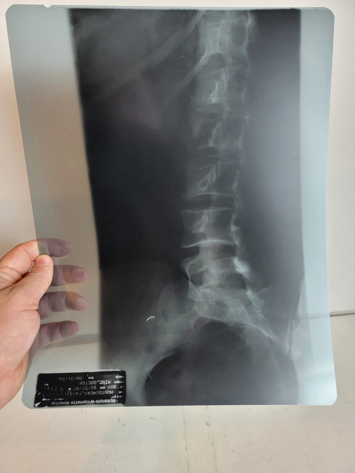 Broken Vertebrae X Ray