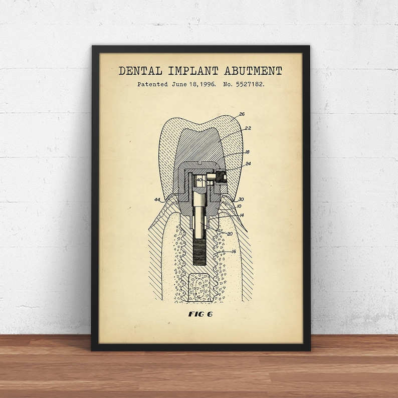 Dental Implant Abutment Patent Print, Blueprint Art, Dental Hygienist ...