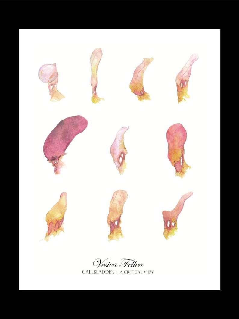 Vesica Fellea- Gallbladder, A Critical View- 18x24 Surgical Anatomy ...