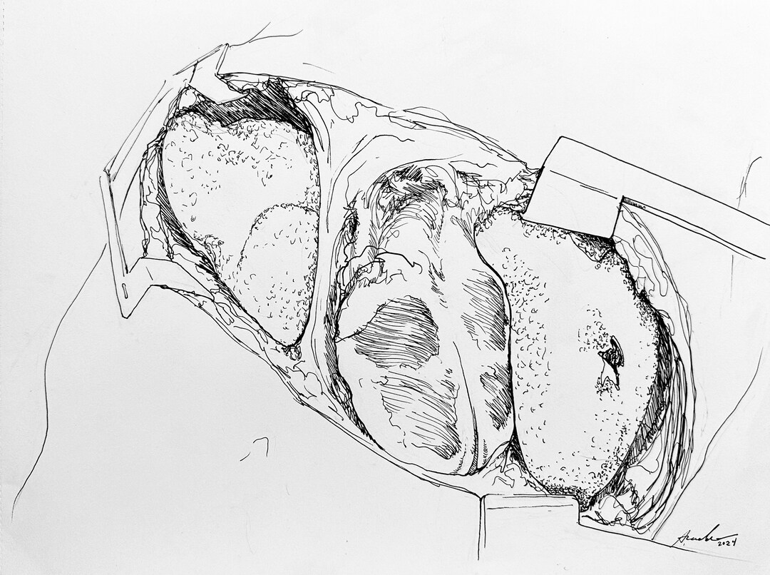 The “clamshell” Exposure- Lung Laceration- Broken Heart- Trauma ...