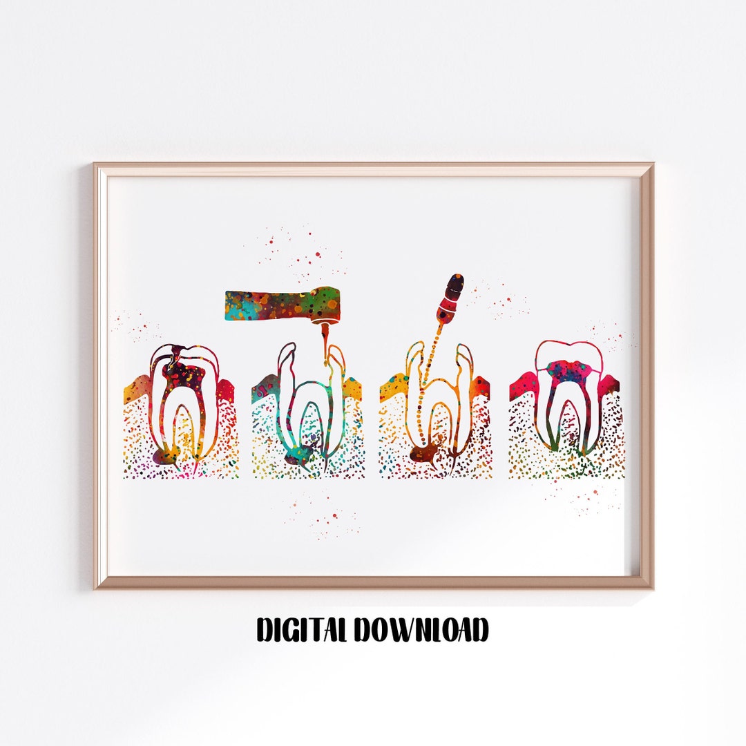 The Root Canal Therapy Treatment Tooth Dental Dentist Office Decor ...