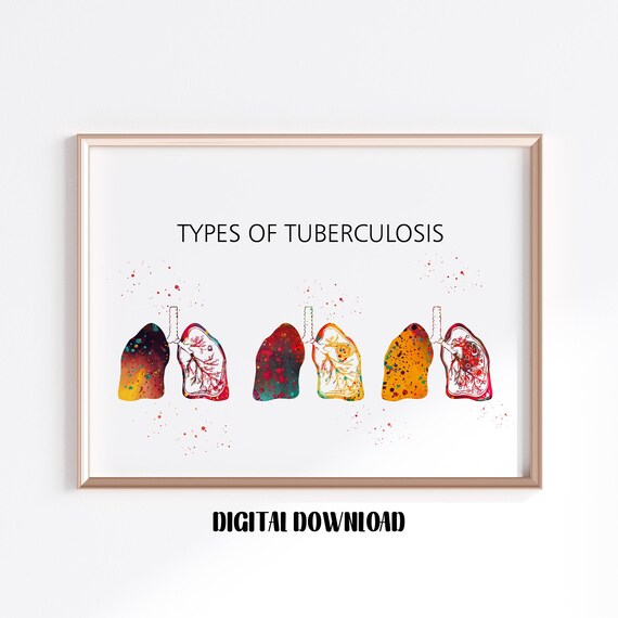 Tuberculosis Types Lung Anatomy Poster Medical Science - Etsy