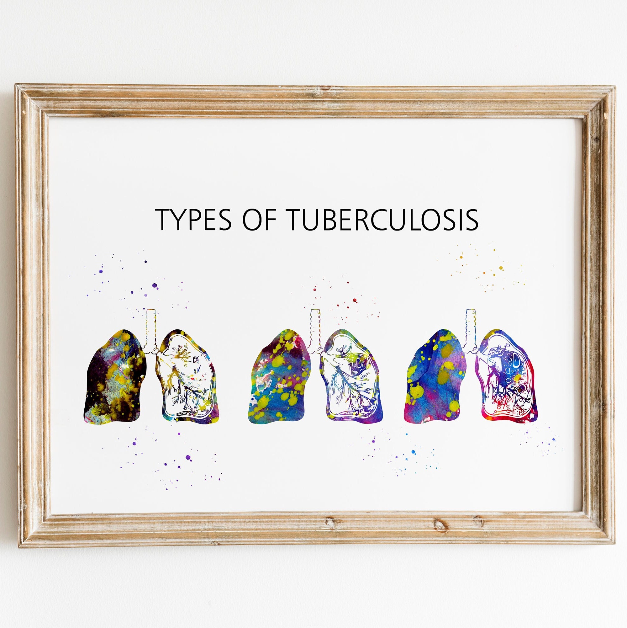 Tuberculosis Types Lung Anatomy Poster Medical Science - Etsy