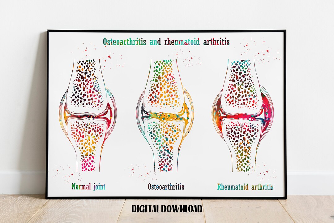 Rheumatology Healthcare Osteoarthritis and Rheumatoid Arthritis Biology ...