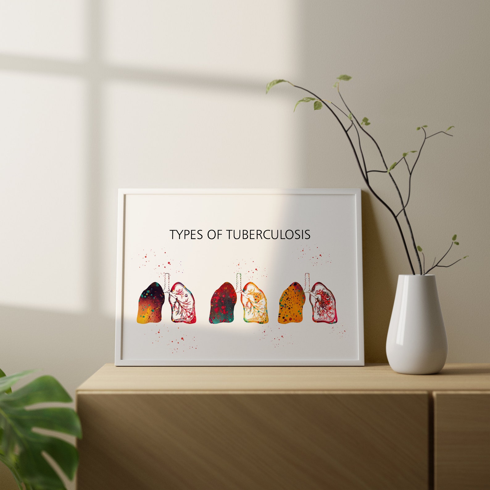 Tuberculosis Types Lung Anatomy Poster Medical Science - Etsy