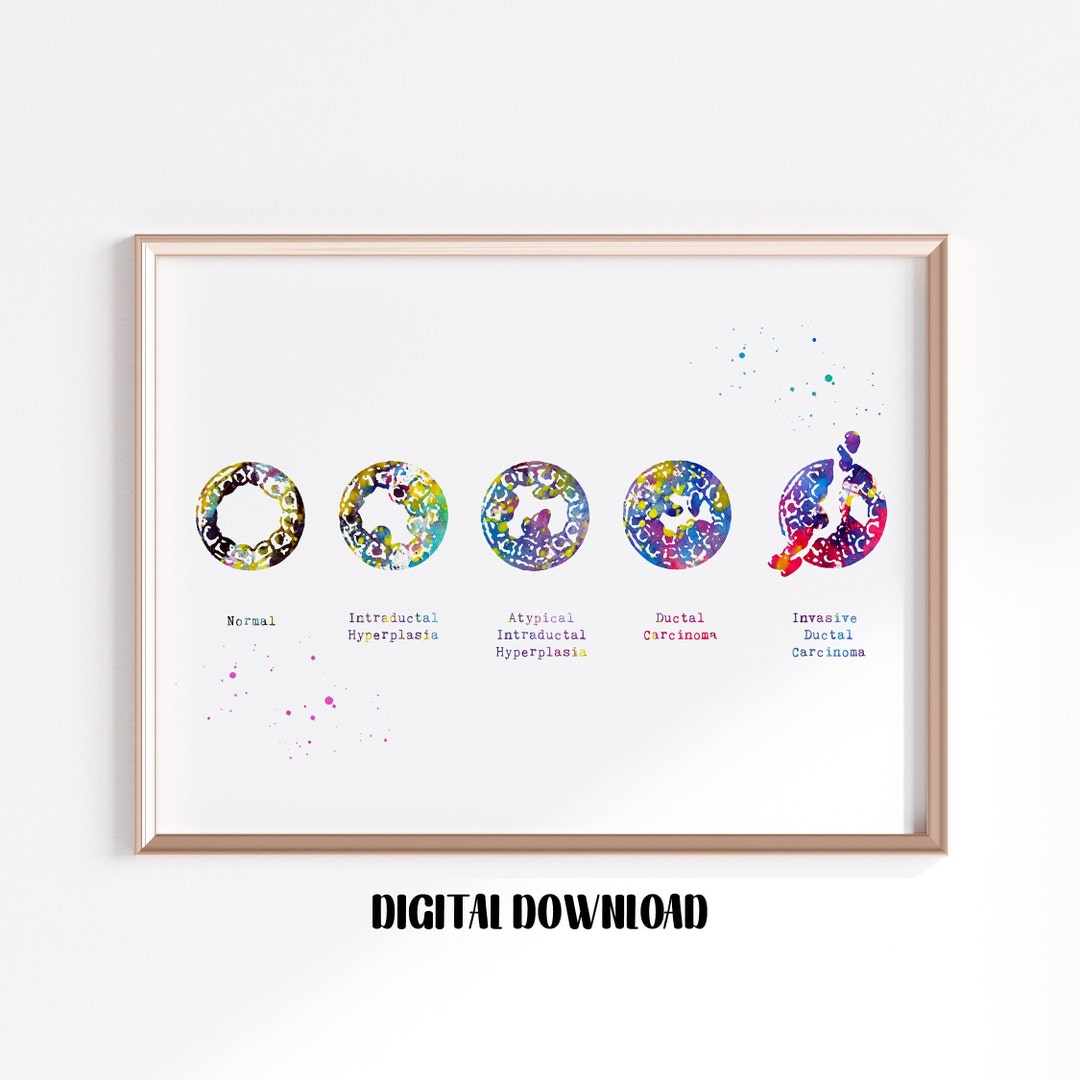 Normal Breast and Breast Cancer Types Anatomy Ductal Carcinoma Poster ...
