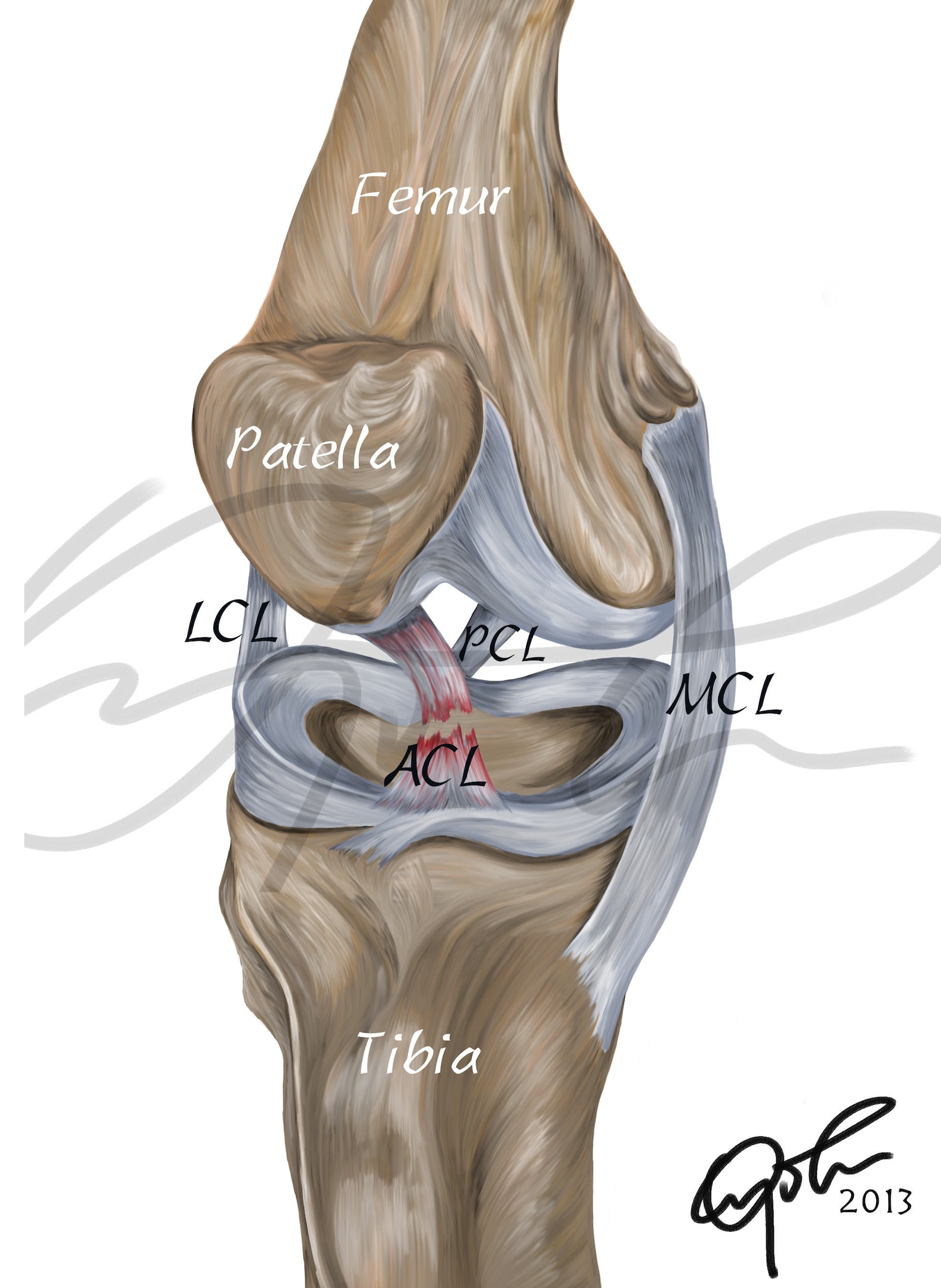 Torn ACL - Printable Download, Digital Illustration, Medical Drawing ...