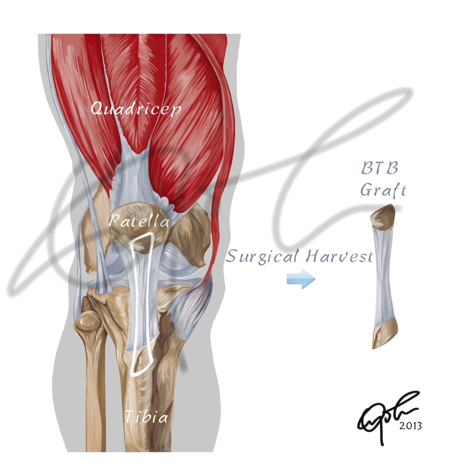 Bone Patellar Bone Graft for ACL Surgery - Printable Download, ACL ...