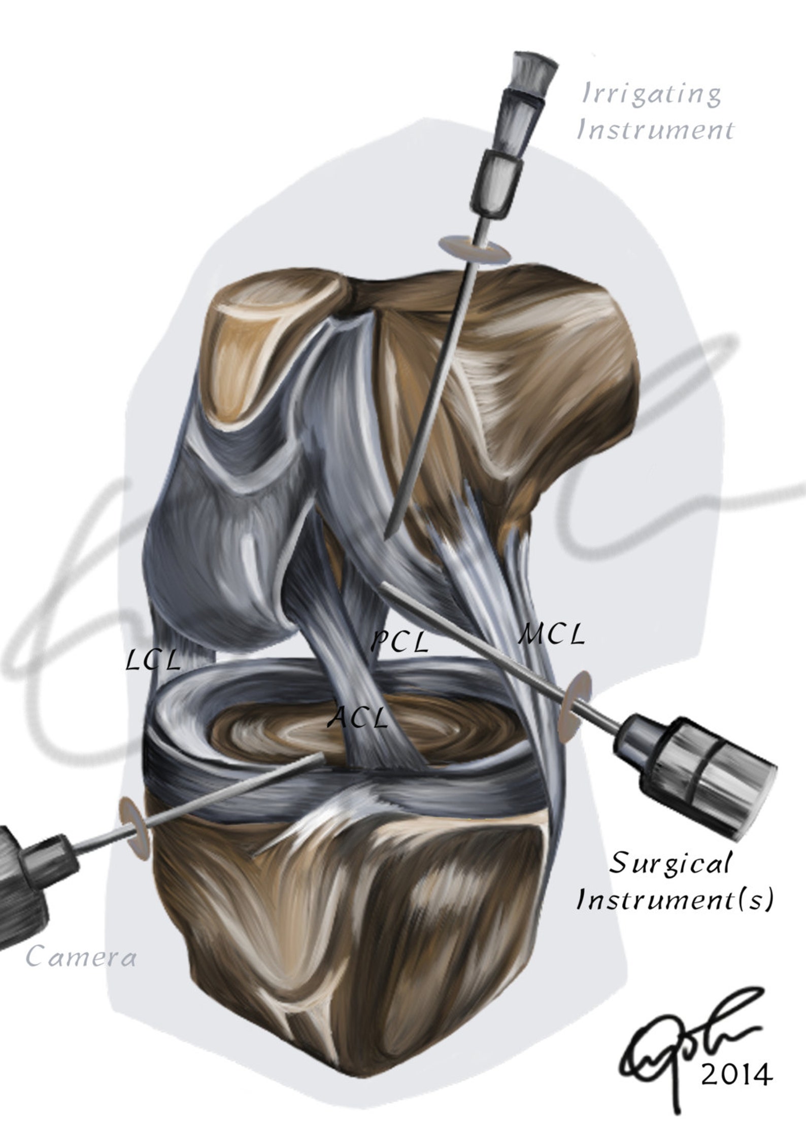 ACL Reconstruction Printable Download - Etsy