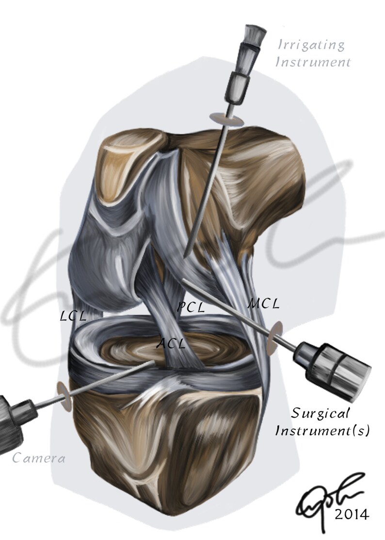 ACL Reconstruction Printable Download - Etsy