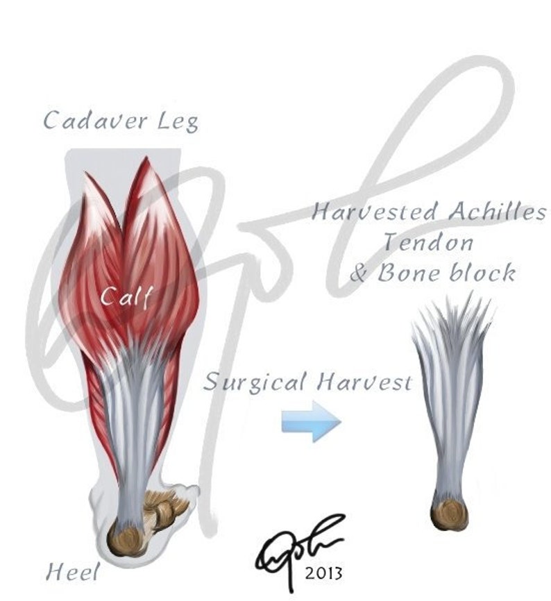 ACL Reconstruction Achiles Tendon Graft - Printable Download - Etsy
