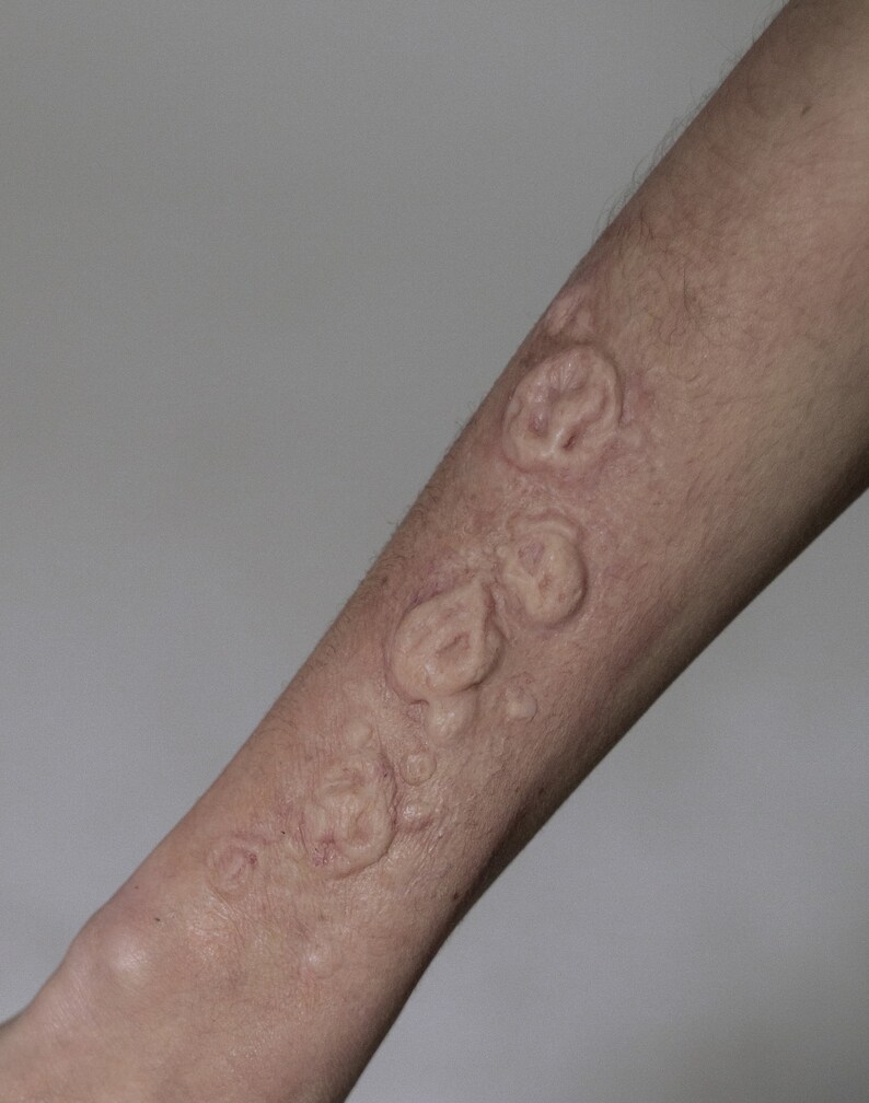 Silicone Prosthetic Zombie Infection GH10-GH13 - Platinum Silicone Gel ...