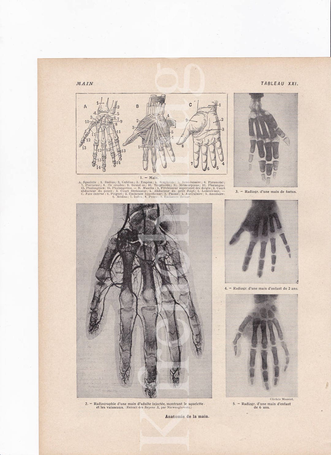 Hand Anatomy Plate French Vintage Original Print 1920's Medical ...
