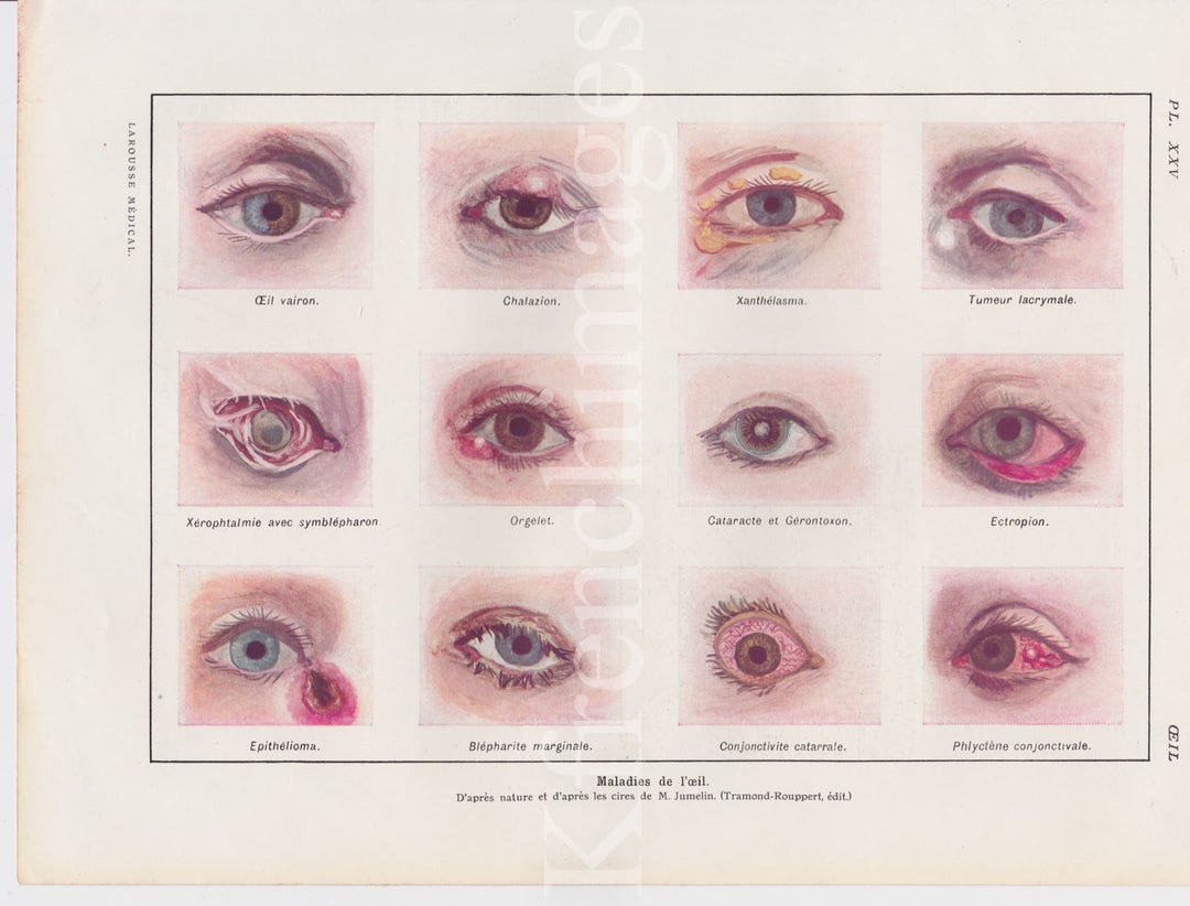 Vintage Eye Disease Print, French Anatomy Illustration, C.1920s - Etsy
