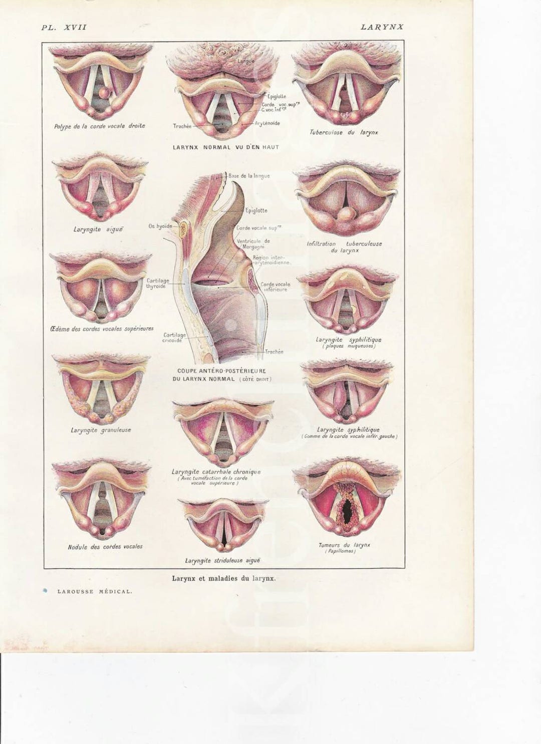Vintage Larynx Anatomy Print, 1920s French Medical Illustration - Etsy