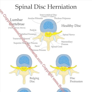 Intervertebral Disc Herniation Illustrations Chiropractic Poster ...