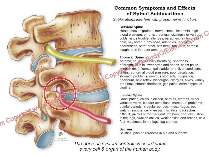 Common Effects of Spinal Subluxation Chiropractic Poster Handout ...