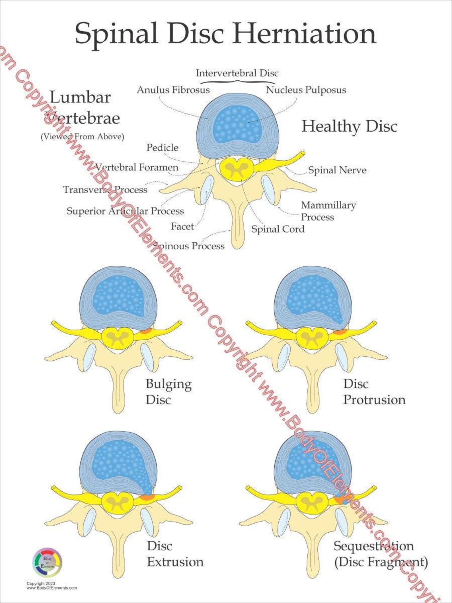 Intervertebral Disc Herniation Illustrations Chiropractic Poster ...