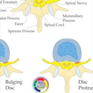 Intervertebral Disc Herniation Illustrations Chiropractic Poster ...