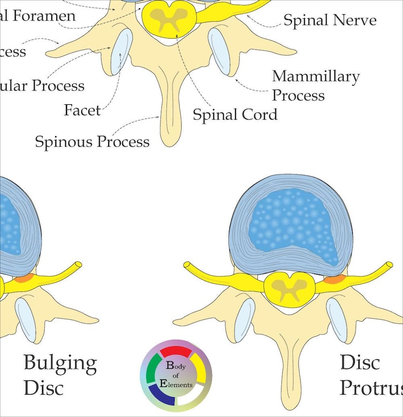 Intervertebral Disc Herniation Illustrations Chiropractic Poster ...