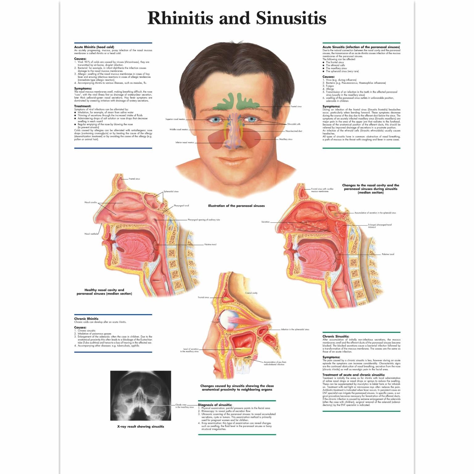 Rhinitis and Sinusitis Chart Anatomy Human Physiology Charts Medical ...