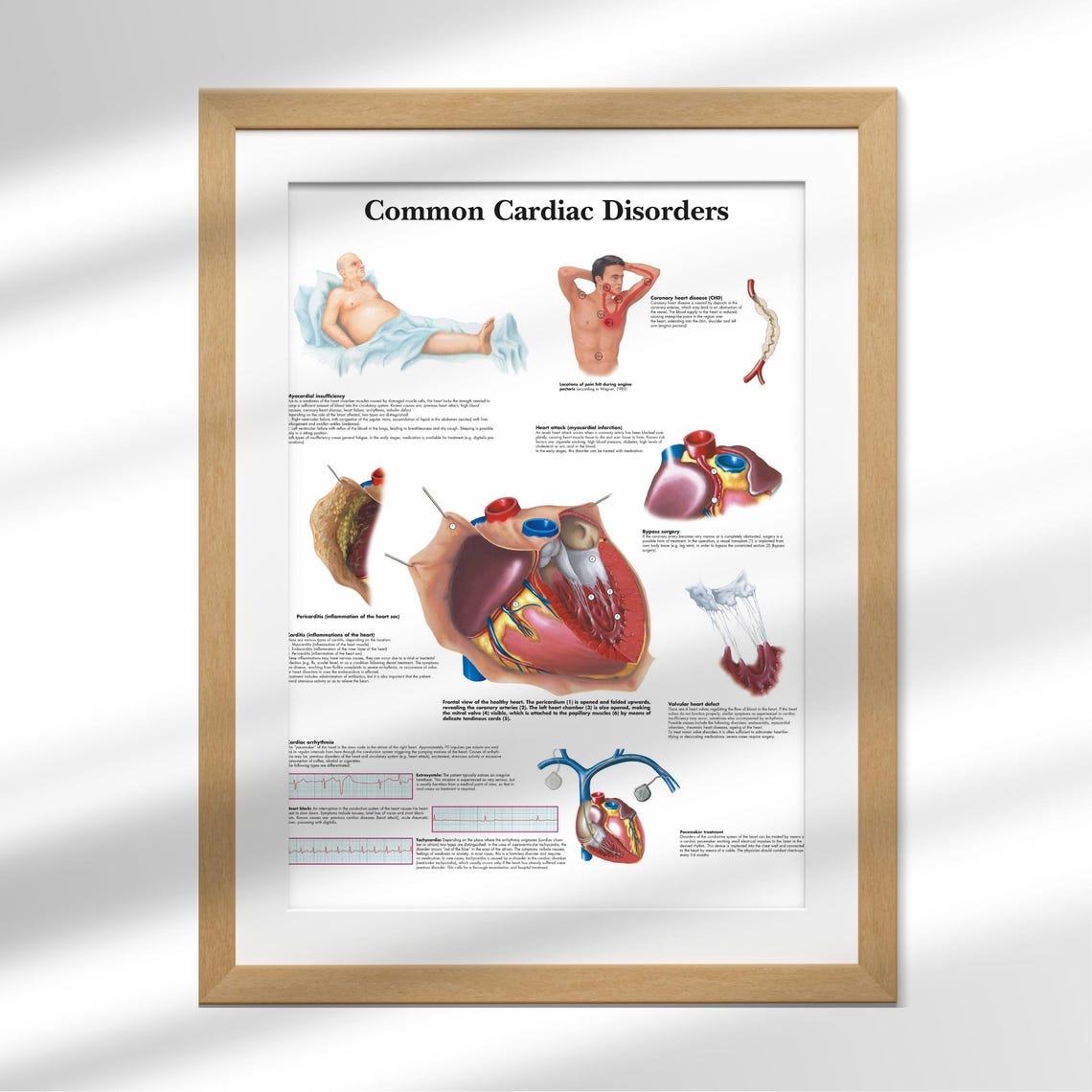 Common Cardiac Disorders Chart Anatomy Human Physiology Charts Medical ...