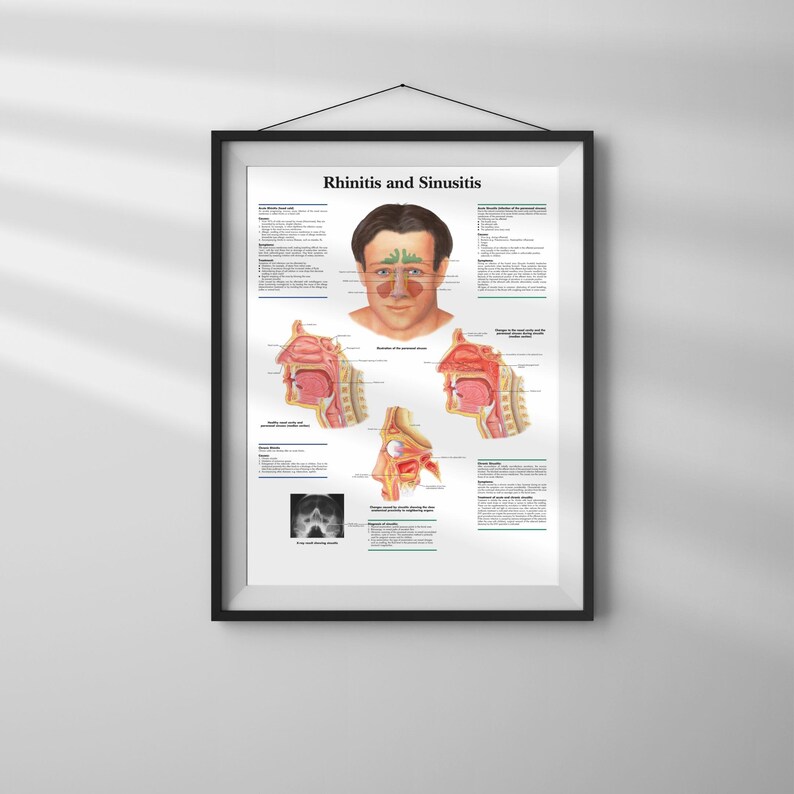 Rhinitis and Sinusitis Chart Anatomy Human Physiology Charts Medical ...