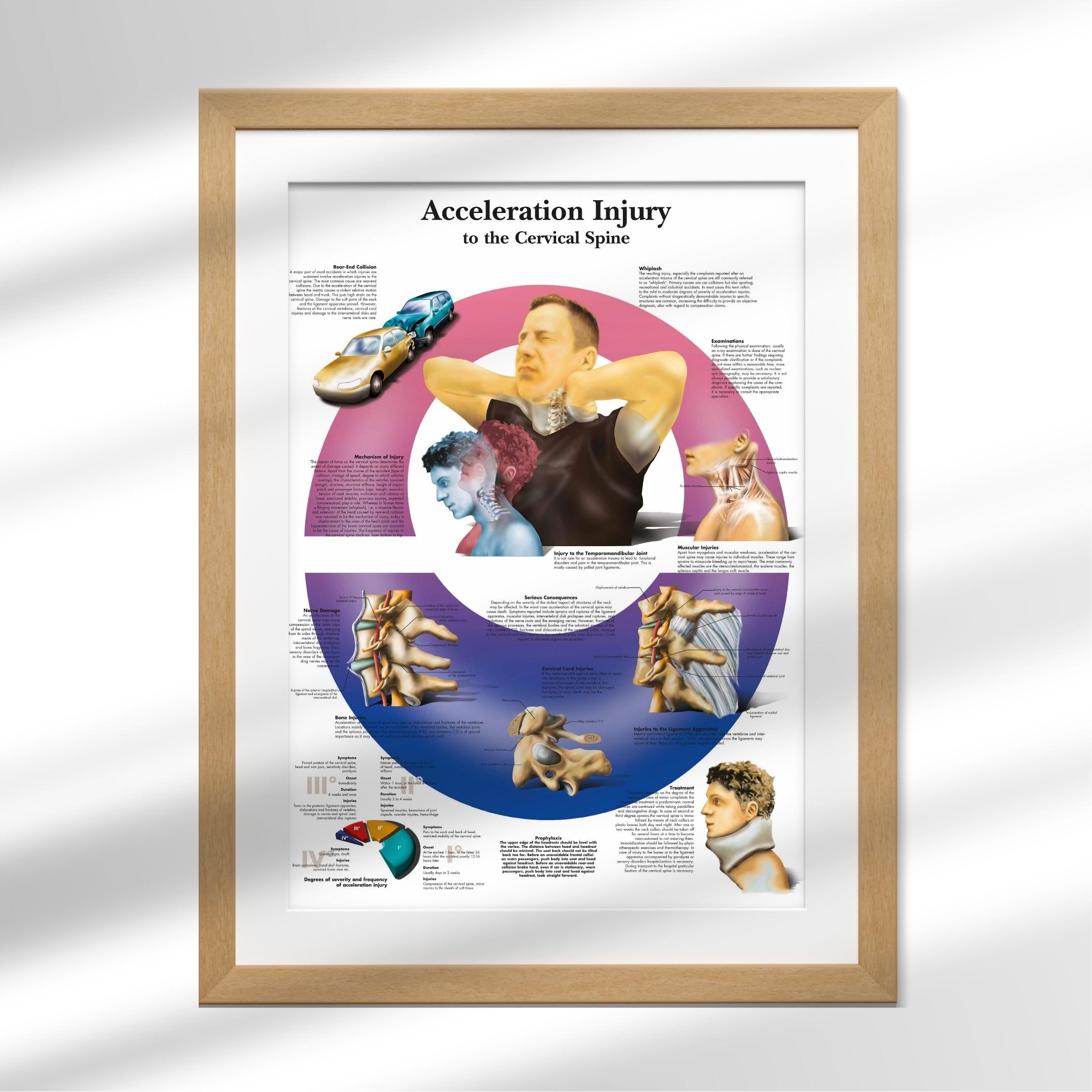 Acceleration Injury Chart Anatomy Human Physiology Charts Medical ...