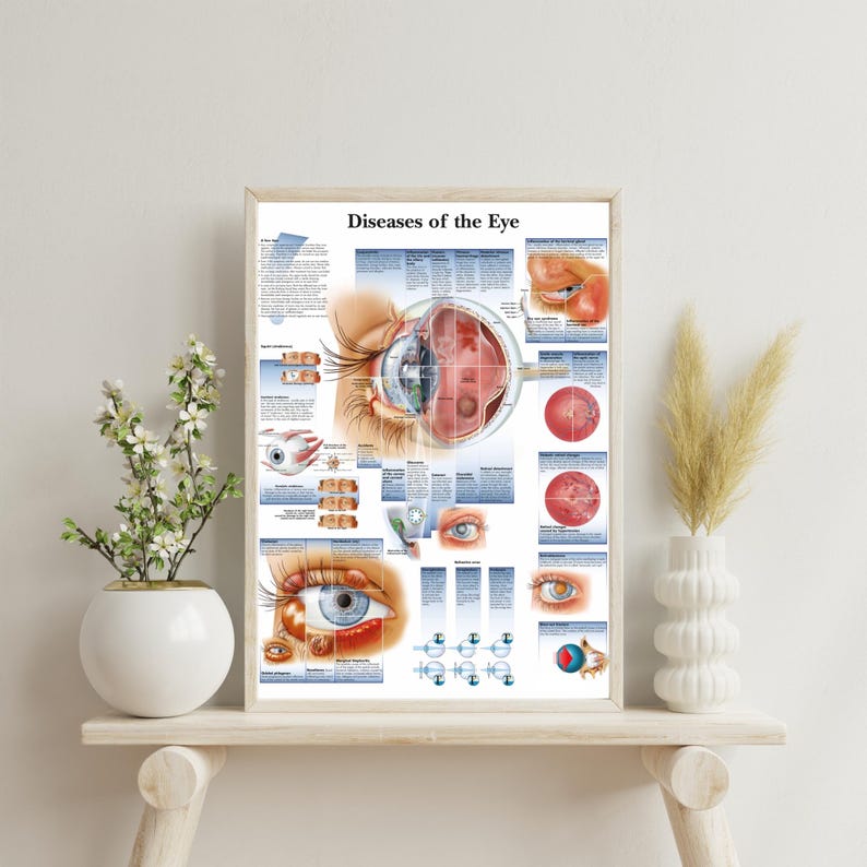 Diseases of the Eye Chart Anatomy Human Physiology Charts Medical ...