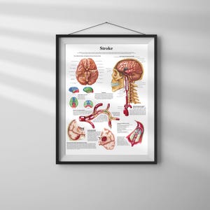 Stroke Chart Anatomy Human Physiology Charts Medical Student Wall ...