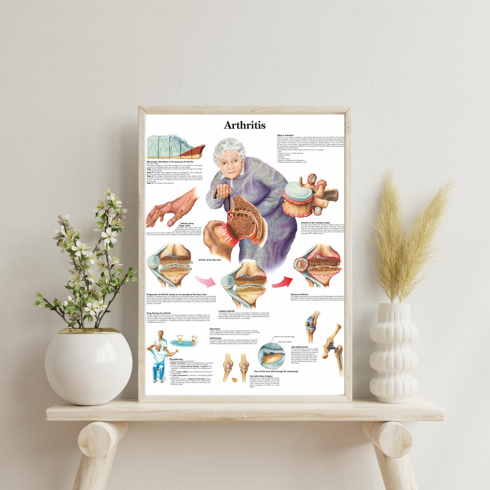 Arthritis Chart Anatomy Human Physiology Charts Medical Student Wall ...